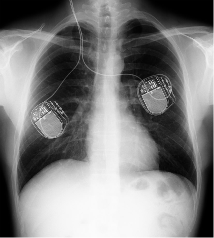 脳深部刺激療法(DBS) | 金沢脳神経外科病院